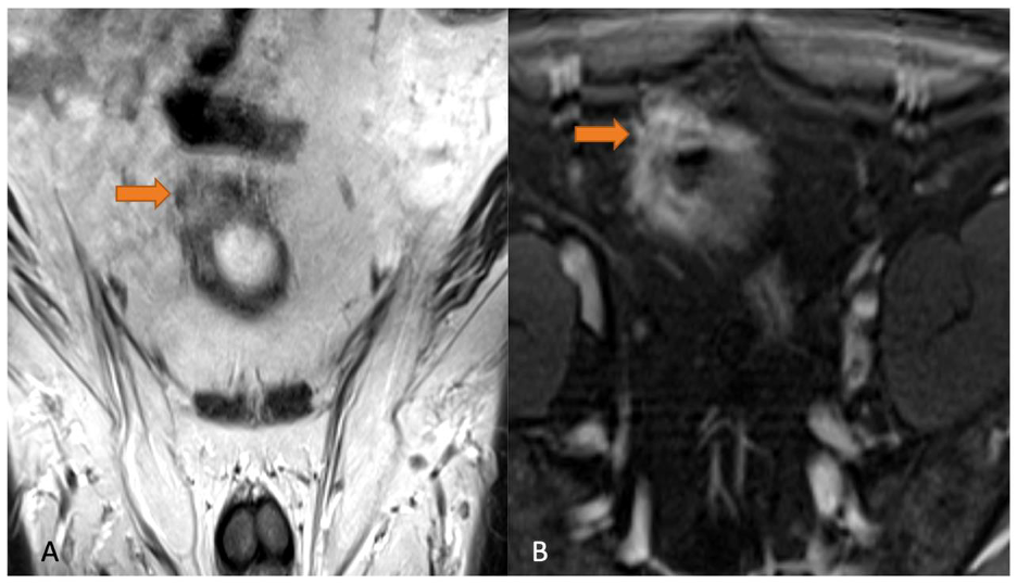 SES AUA 2022: Extramural Venous Invasion: A Novel Magnetic Resonance ...
