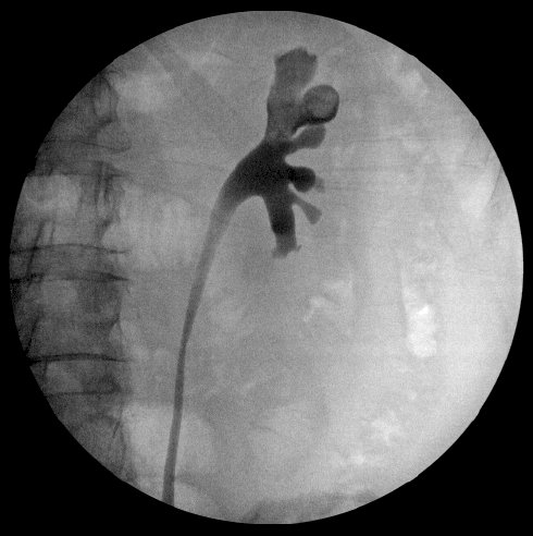 High-Grade Upper Tract Urothelial Carcinoma with Good Renal Function