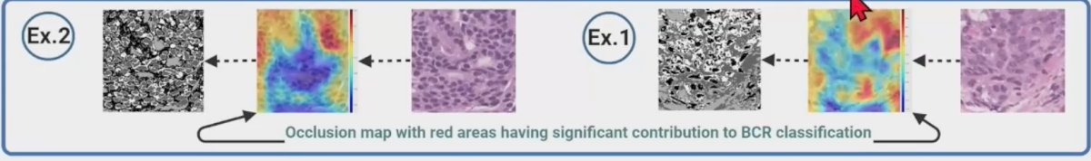 ASTRO 2023: Post-Prostatectomy Risk Stratification of Biochemical ...