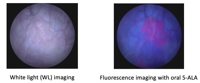 AUA 2024: Diagnostic Performance of Photodynamic Diagnosis with Oral 5 ...