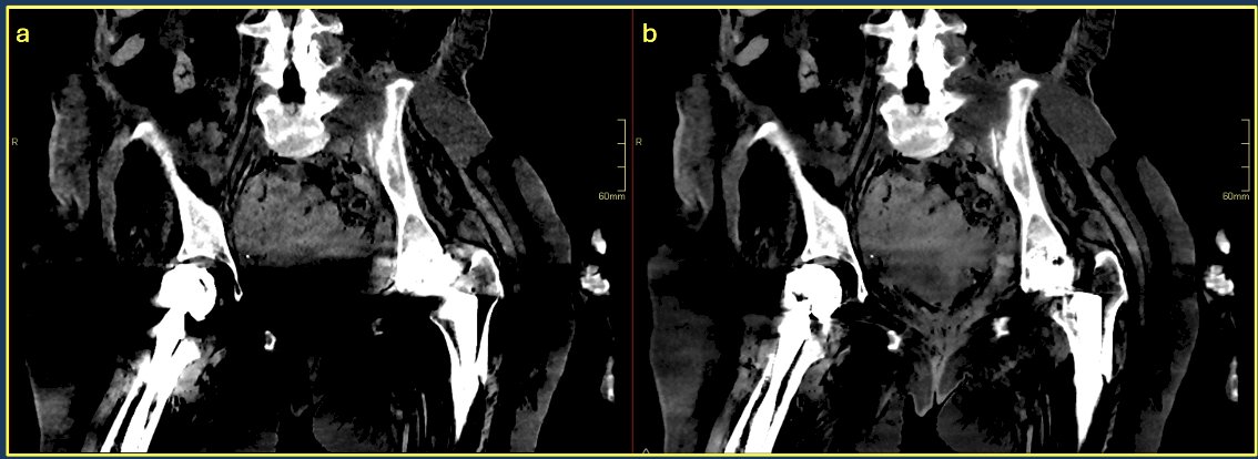 AUA 2024: Does Deep Learning Reconstruction Improve Ureteral Stone ...
