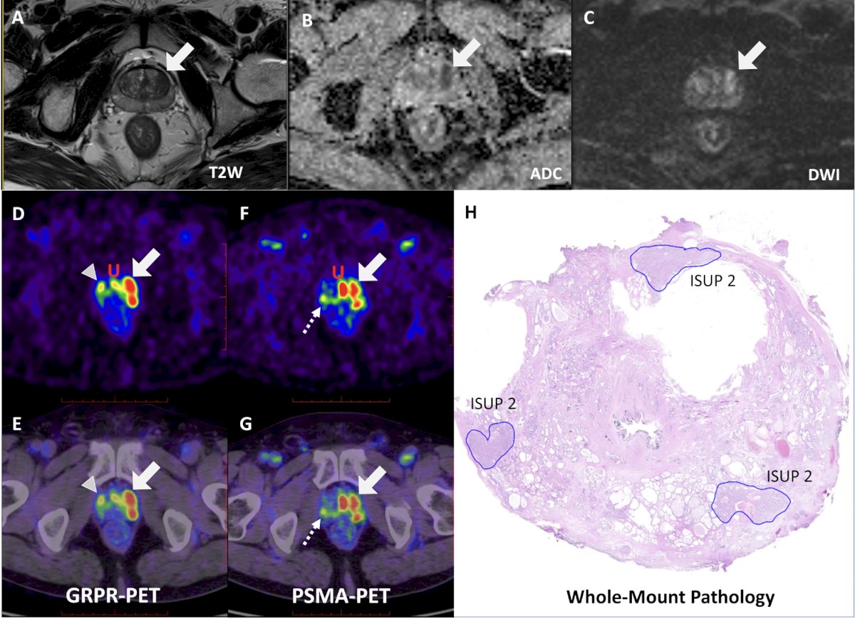 SNMMI 2025: Head-to-Head Comparison of mpMRI, PSMA, and GRPR PET/CT for ...