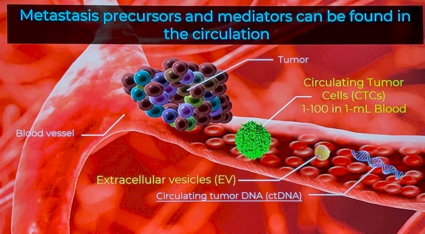 WCET 2025: Current Advances in Liquid Biopsies for Prostate Cancer