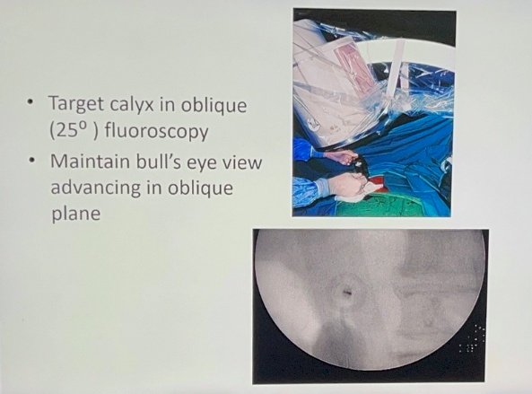 WCET 2025: Panel: Percutaneous Nephrolithotomy Access