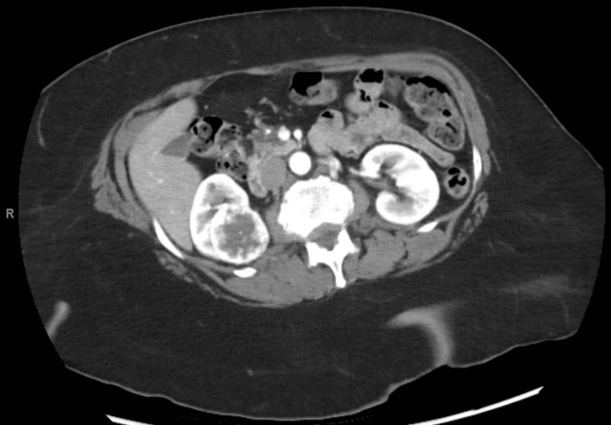 SCS AUA 2025: Techniques for Surgical Treatment of RCC with Morbidly ...
