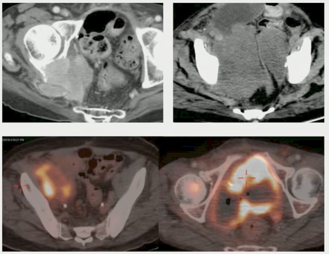 ASTRO 2025: Bladder Adjuvant Radiotherapy (BART): Clinical Outcomes ...