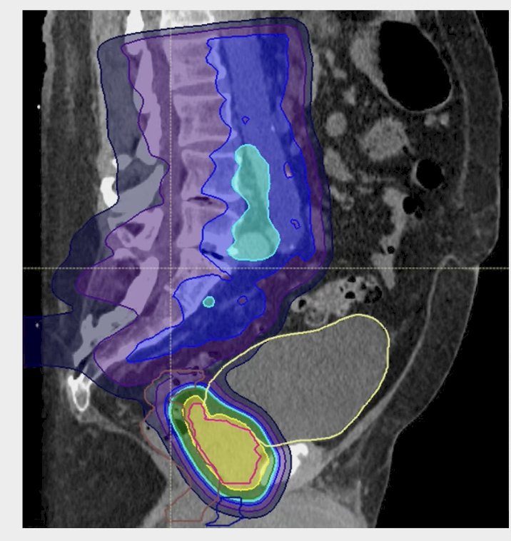 ASTRO 2025: Interim Analysis of a Phase 2 Single Arm Trial of Extended ...