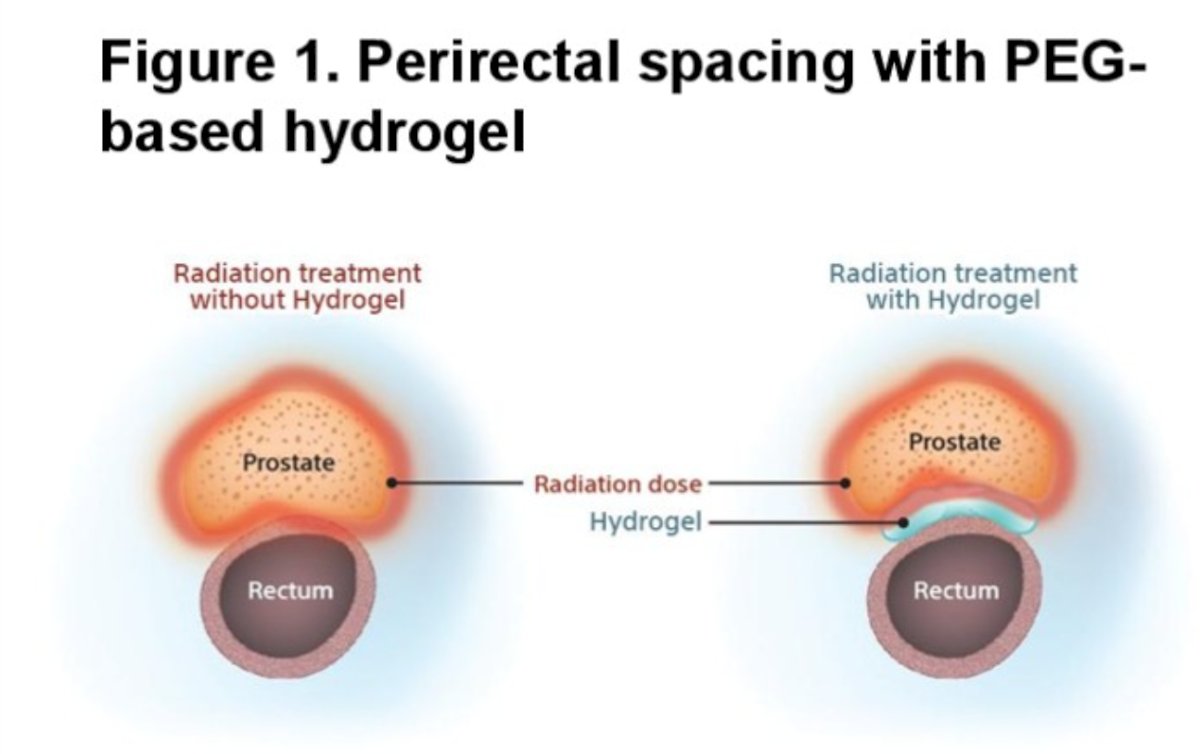 Prostate Radiotherapy Treatment