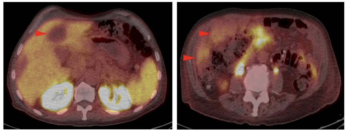 How to Read a PSMA PET Scan