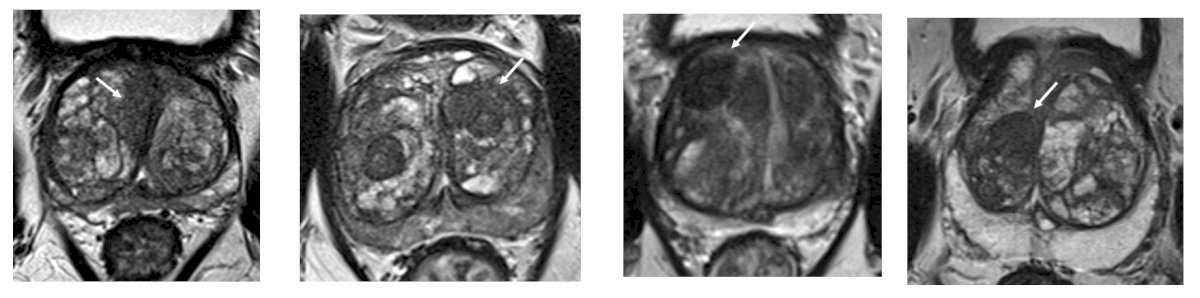 Prostate mpMRI in Practice: Anatomy, PI-RADS Scoring, and Quality ...