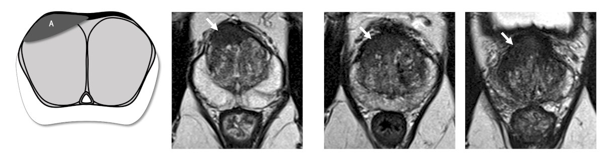 Prostate mpMRI in Practice: Anatomy, PI-RADS Scoring, and Quality ...