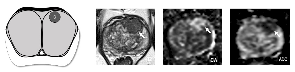 Prostate mpMRI in Practice: Anatomy, PI-RADS Scoring, and Quality ...