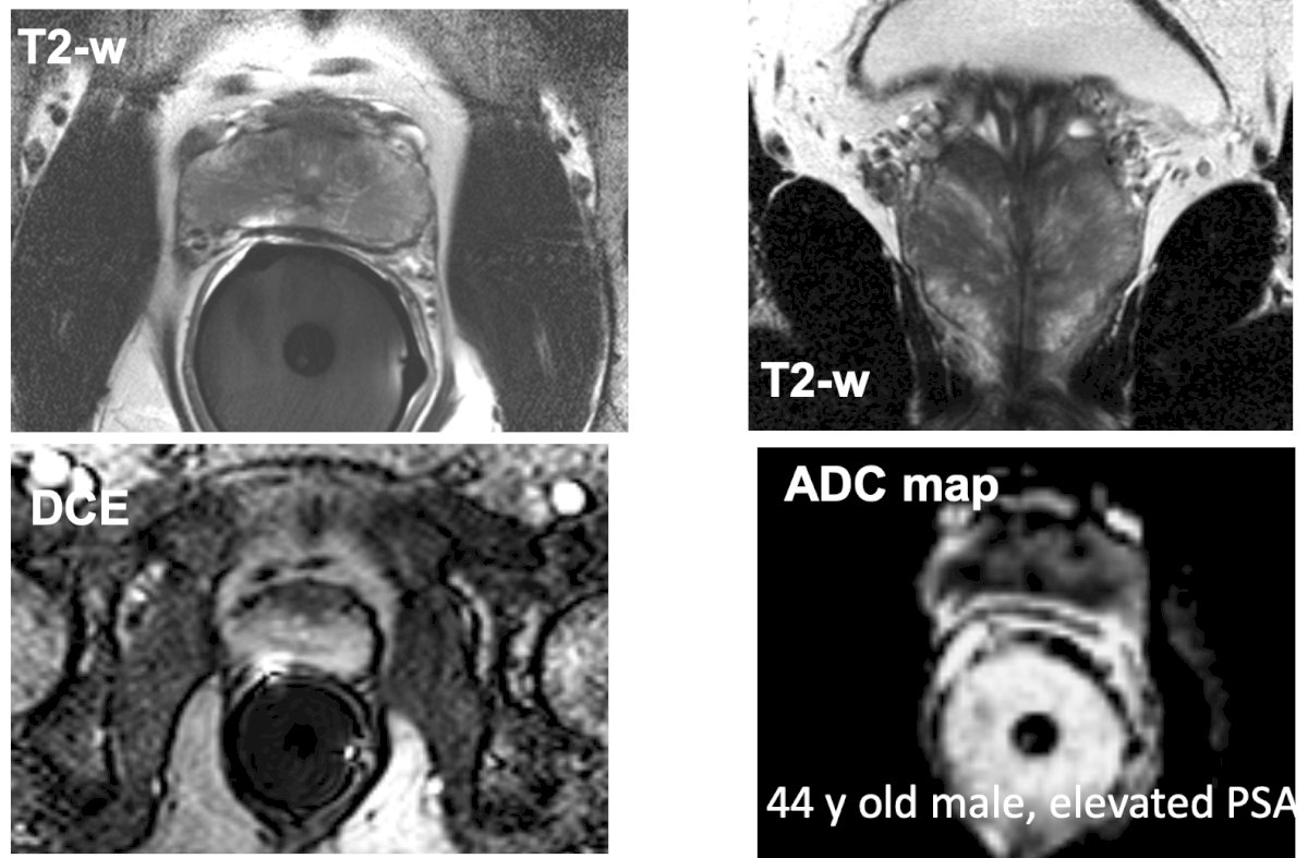 Prostate mpMRI in Practice: Anatomy, PI-RADS Scoring, and Quality ...