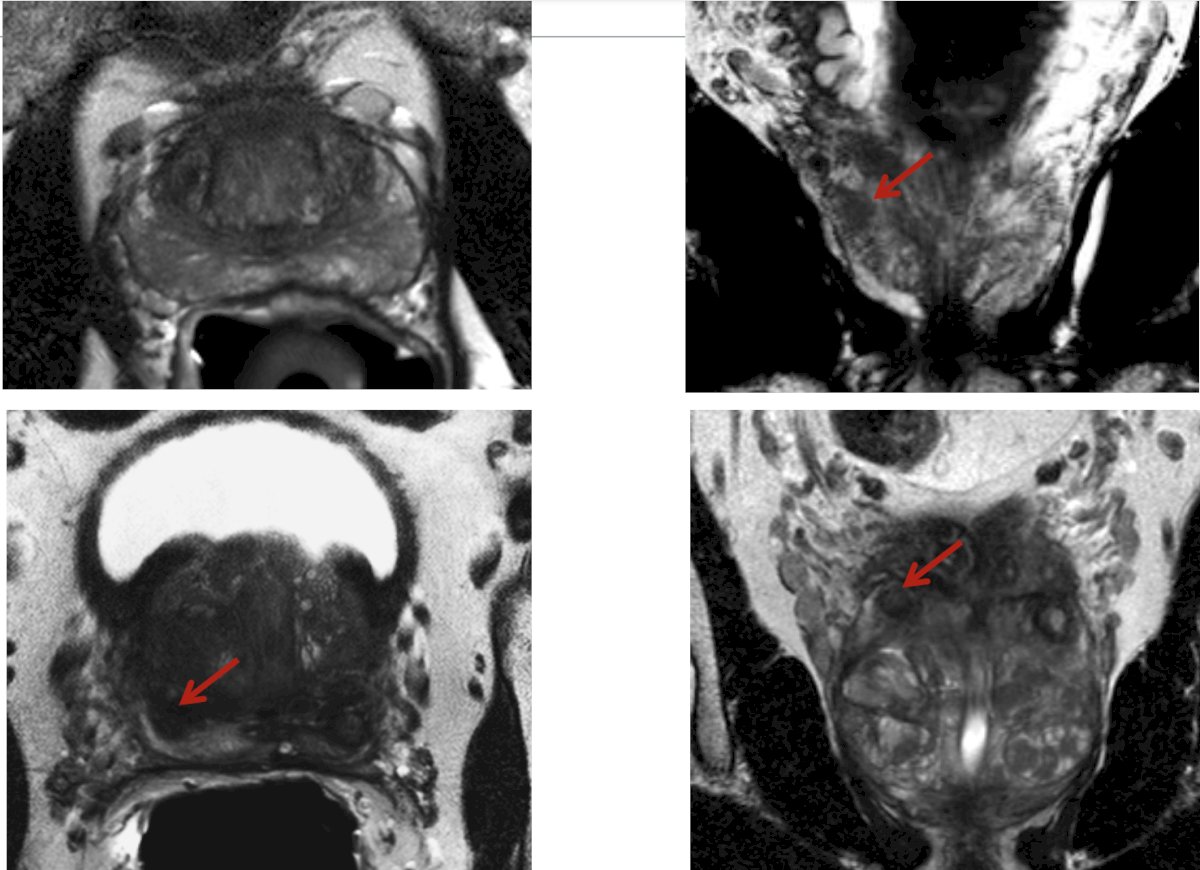 Prostate mpMRI in Practice: Anatomy, PI-RADS Scoring, and Quality ...