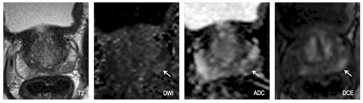 Prostate mpMRI in Practice: Anatomy, PI-RADS Scoring, and Quality ...