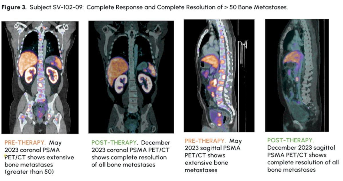 SUO 2025: Effective Resolution of Bone Metastases in Patients with ...