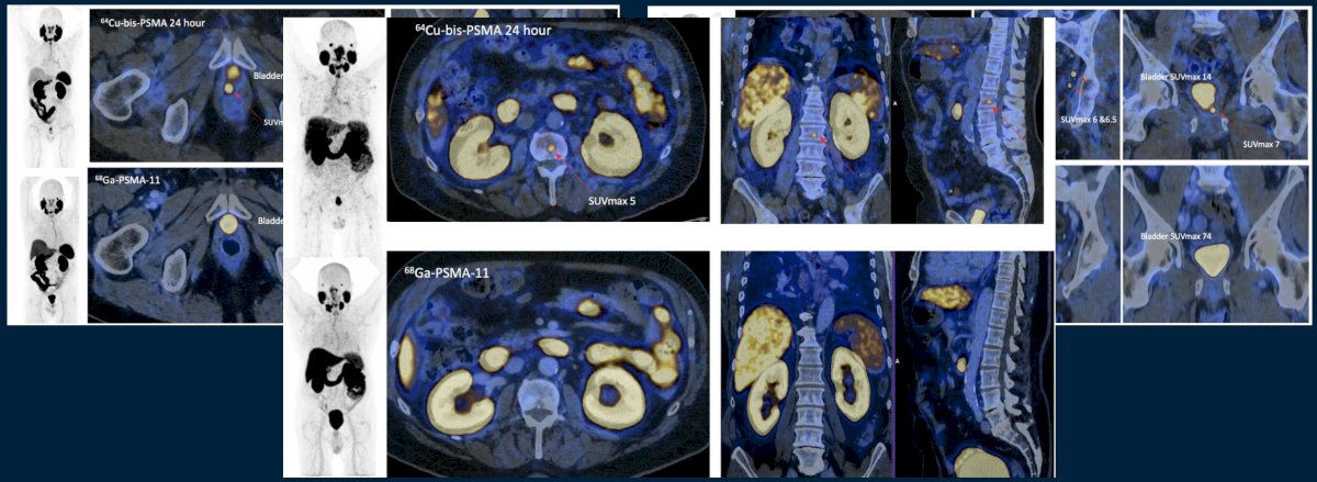 EAU 2026: Co-PSMA Trial: Prospective Comparison of 64Cu-SAR-Bis-PSMA ...