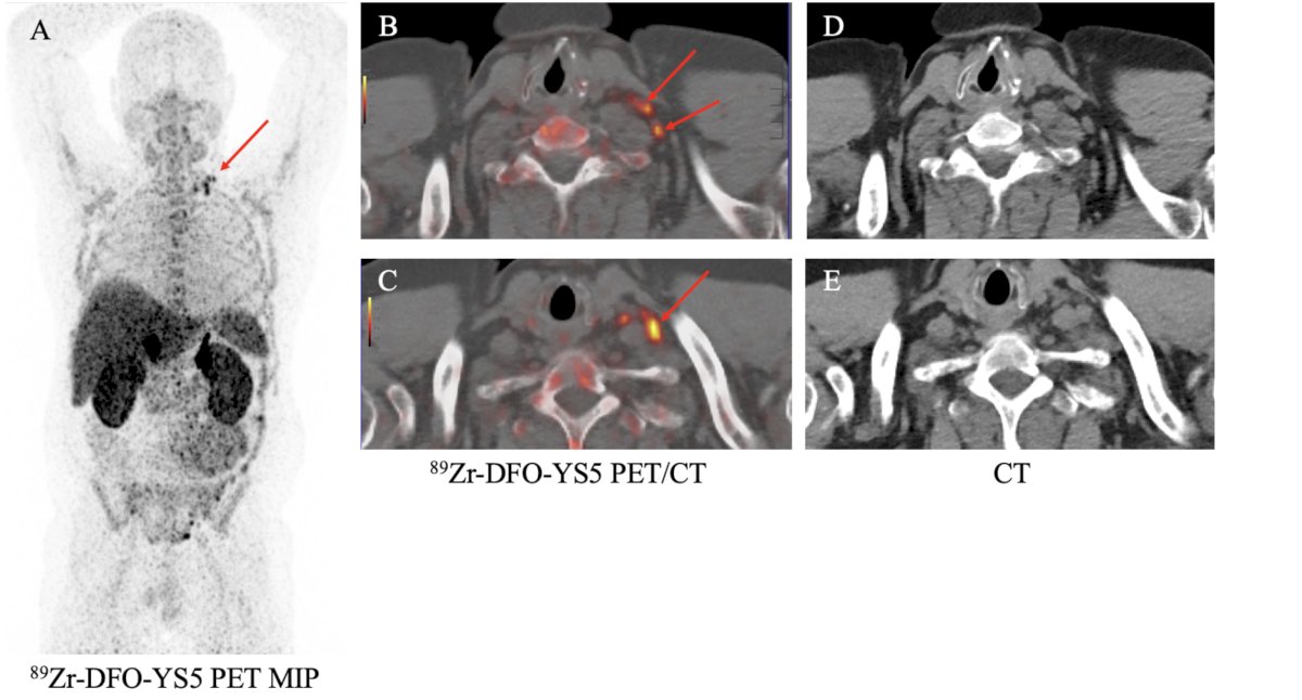 SNMMI 2026: First in Human CD46-Targeted ImmunoPET Imaging with 89Zr ...