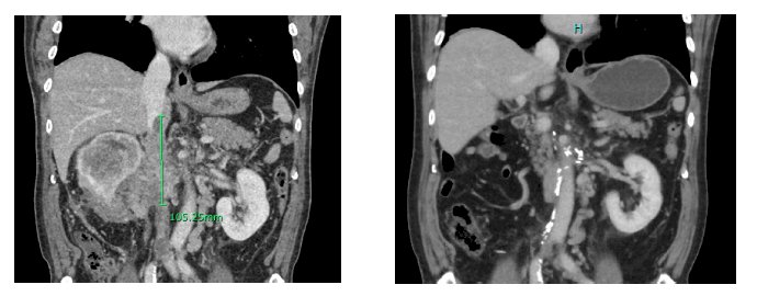 AUA 2022: Outcomes of Nephrectomy for Renal Cell Carcinoma with Venous ...