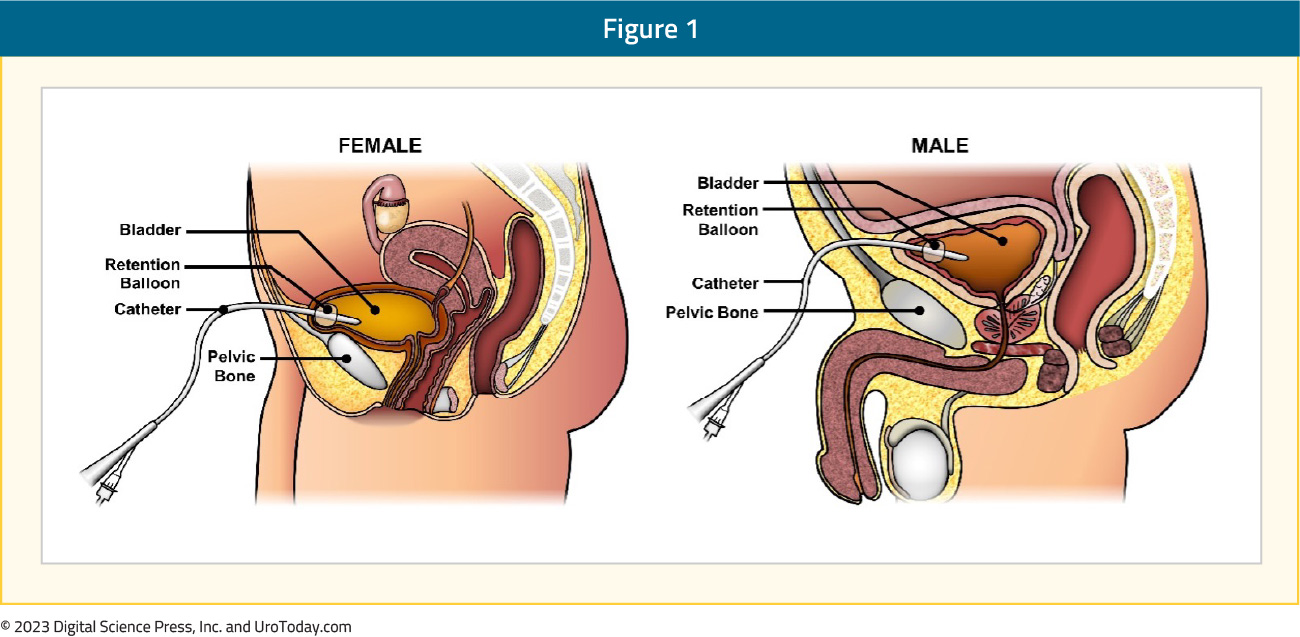 Suprapubic Cystostomy Suprapubic Cystostomy