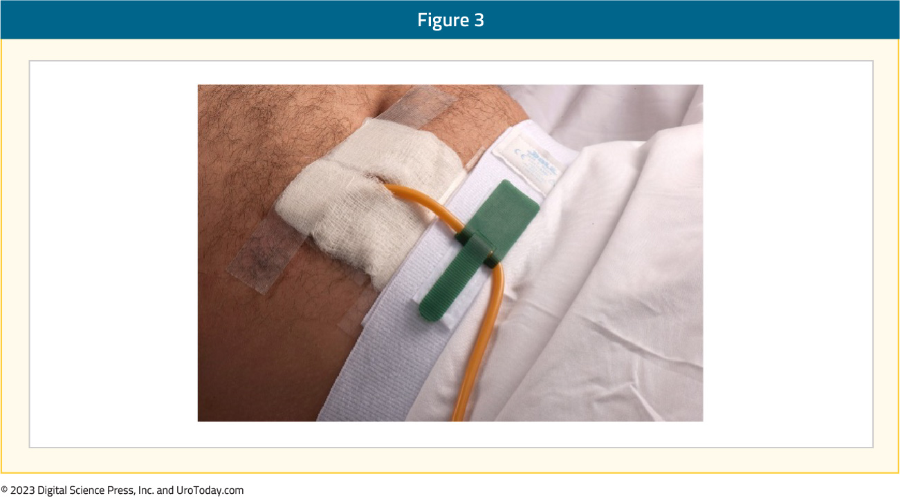 Suprapubic Catheter Suprapubic Catheter